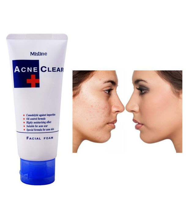 Mistine Acne Clear Facial Foam 85g | Daraz.pk