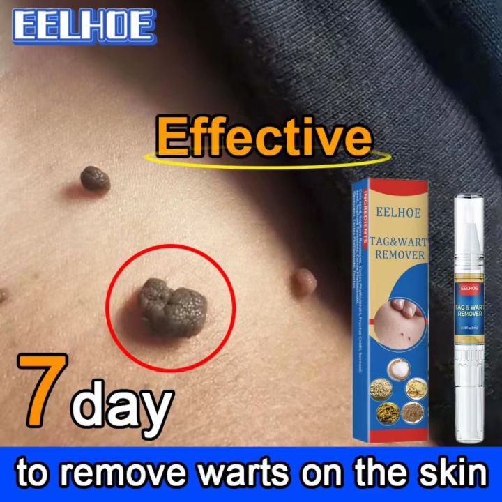 Skin Tag Wart Mole Remover Liquid – Easy to Use Homeopathic Medicine ...
