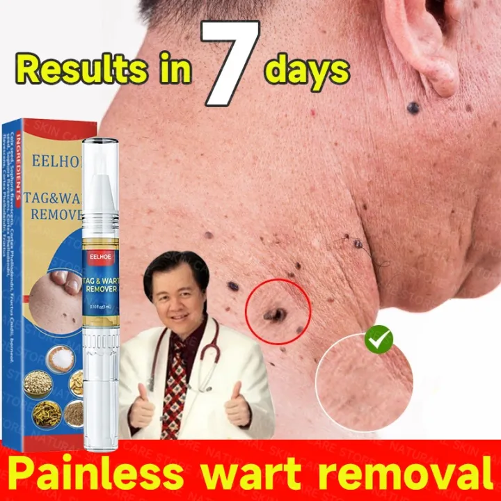 Skin Tag Remover Pen – Easy Home Treatment for Warts, Moles & Skin Tags ...
