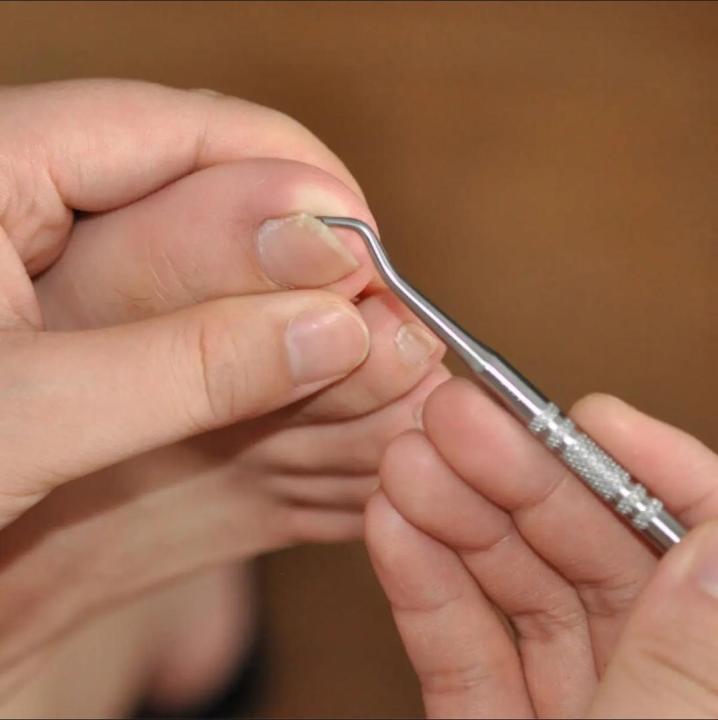 INGROWN TOENAIL LIFTER DOUBLE SIDED TOOL PROFESSIONAL GRADE | Daraz.pk