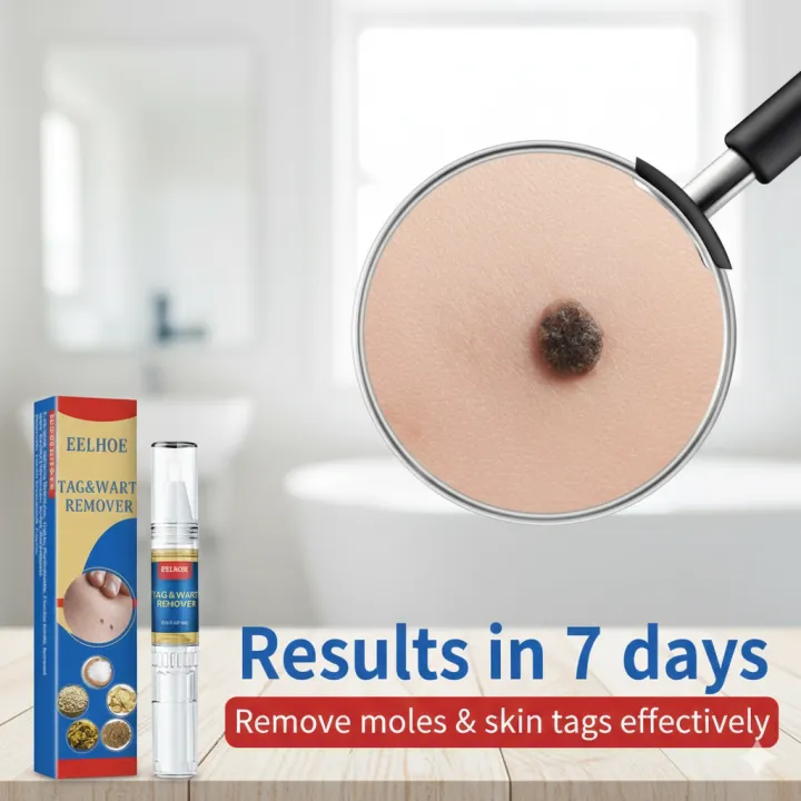 Skin Tag Remover Pen for Warts, Moles & Skin Tags – Safe & Easy Home ...