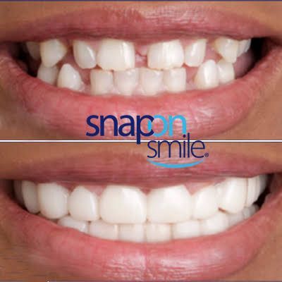 Upper & Lower Snap-In Teeth Veneers | Soft Silicone Denture Wraps ...