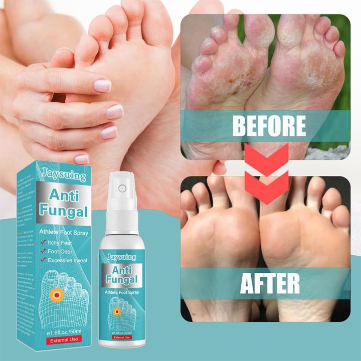1PCS Anti Fungal Athlete Feet Spray Sterilize Toe Paronychia Foot ...