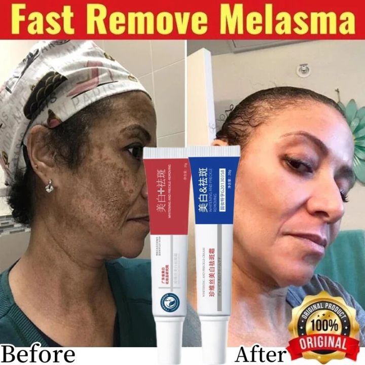 Lethe Ling Freckle Whiten Cream Effective Removing Spot Eliminate Brown ...