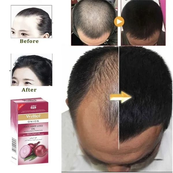 Wellice Onion Essence Oil for Hair Growth Anti Hair Loss Formula 2 in 1 150ml | Daraz.pk