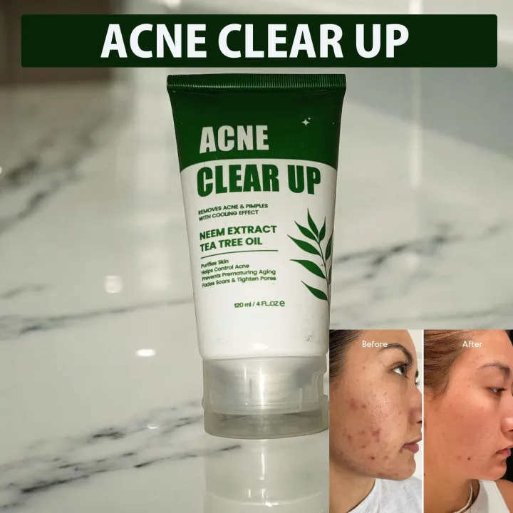 Acne Clear Up Face Wash 120 ml Oil Control & Acne Treatment Clear Skin Formula | Daraz.pk