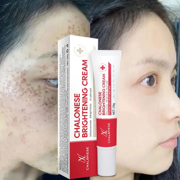 Chalonese Brightening Cream 20g for Acne Marks & Pigmentation | Daily ...