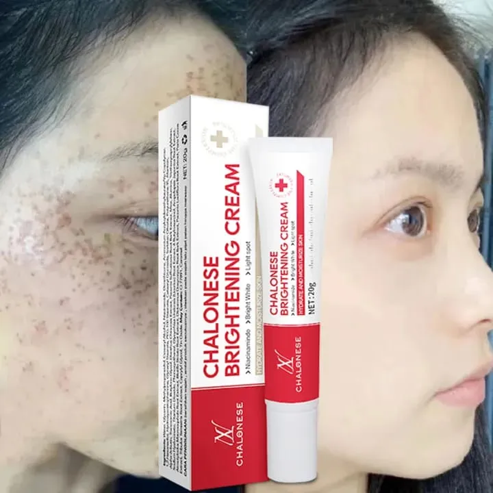 Chalonese Brightening Cream 20g for Acne Marks & Pigmentation | Daily ...