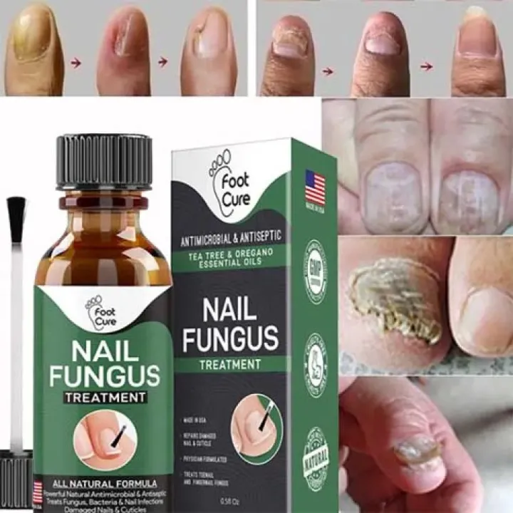 Nail Fungus Treatment Stop Fungal Growth Effective Fingernail 10ml ...
