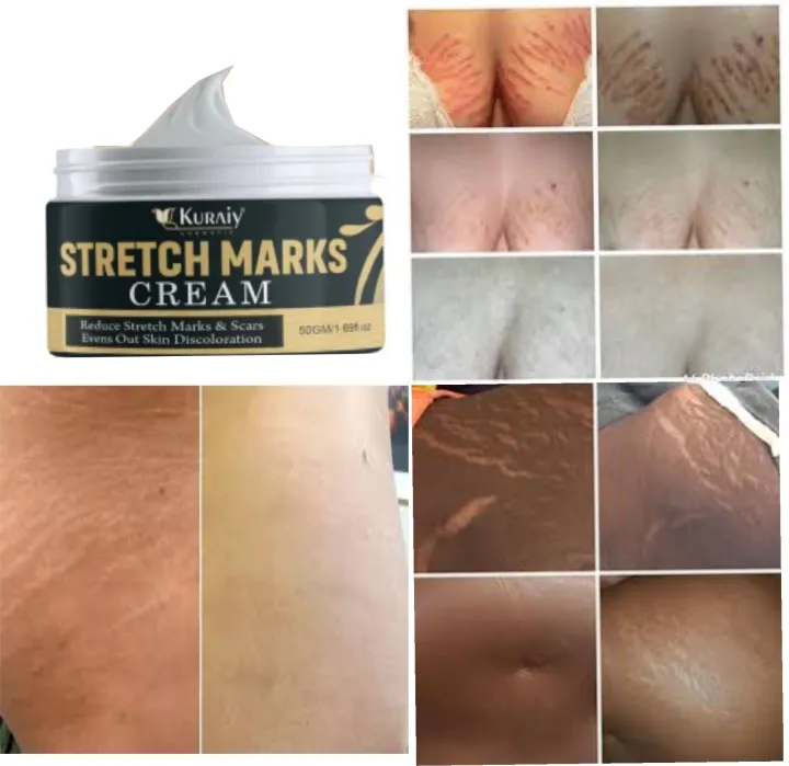 Pregnancy Stretch marks removal cream for Women, during after pregnancy ...