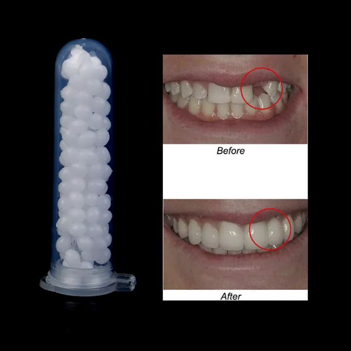1×5g Denture Adhesive Temporary Tooth Cosmetic Repair Kit Teeth Gaps ...